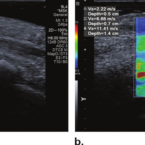 Normal Fourth Extensor Compartment Tendon Of The Wrist In A 21 Year Old Download Scientific