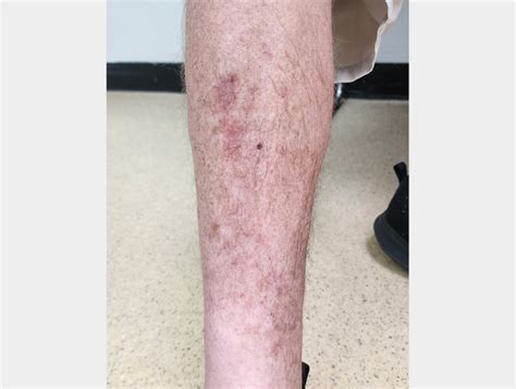 Racgp Pruritic Papules Of The Leg