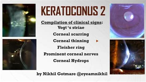 Keratoconus Archives Meduweb