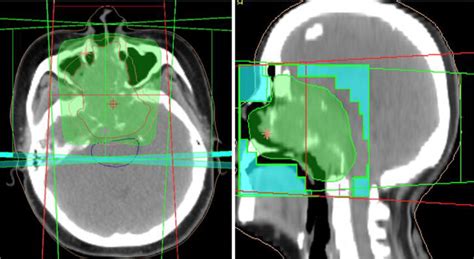Dosimetric Planification Of Rt In Axial Left And Sagittal Right