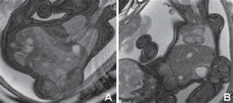 Fetal Mri T2 Weighted Image Showing The Dicephalus Tetrabrachiusdipus Download Scientific