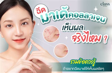ฉีดมาเด้คอลลาเจน Classclinic