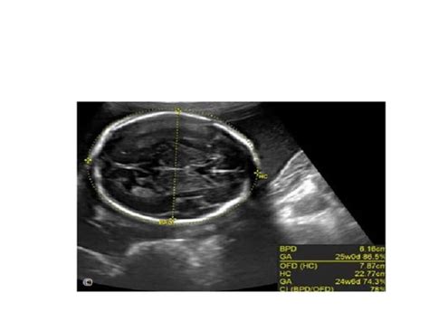 Obstetric Ultrasound Radiology Pptx