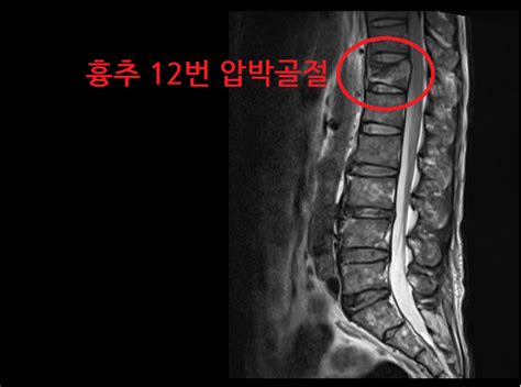 척추압박골절 흉추압박골절 후유장해 보상 흉추 12번 네이버 블로그