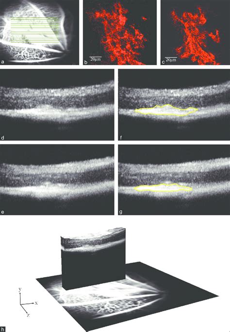 Choroidal Neovascularization Cnv Lesion Images Were Taken And Marked