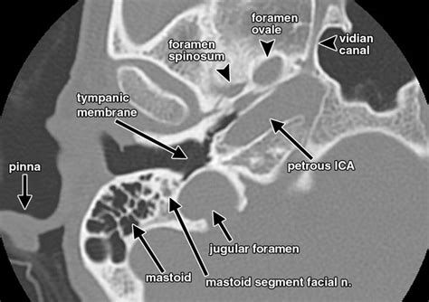 Interactive Web Based Learning Module On Ct Of The Temporal Bone