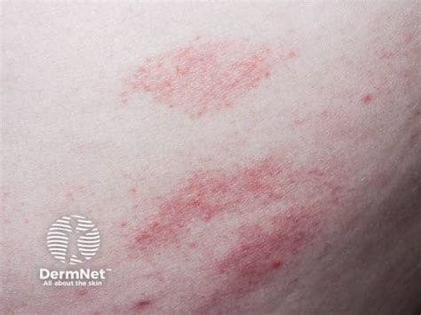 Parapsoriasis Treatment