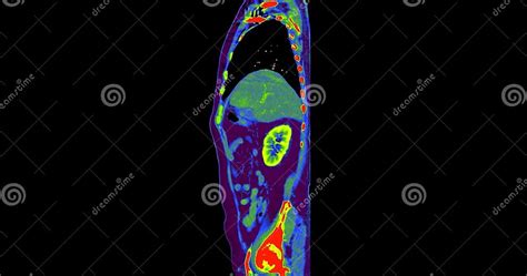 Ct Chest And Abdomen With Injection Contrast Media Sagittal Plane For