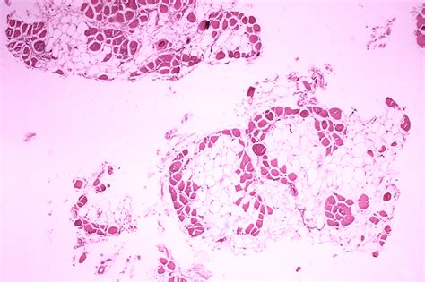 Arrhythmias And Cardiac Dysfunction In Duchenne And Becker Muscular
