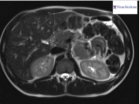 30 Year Old Man With Known Anatomic Variant Auntminnie