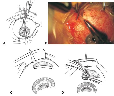Limbus Based Conjunctival Flap American Academy Of Ophthalmology