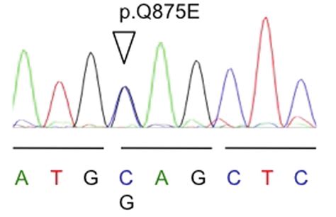 Sequence Electropherogram Of The Heterozygous Missense Mutation P Q875e