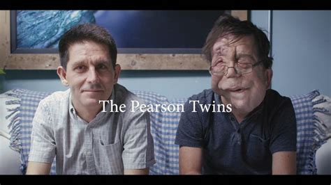 The Pearson Twins Short Film Rare Genetic Disorders Pearson