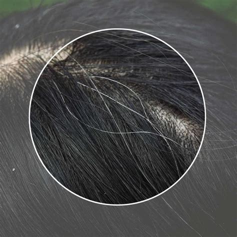 Leukotrichia Whitening Of Hairs