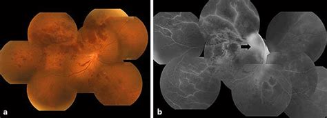 Funduscopy A And Fluorescein Fundus B Images Obtained At 50 Days Download Scientific