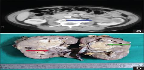 Synchronous Urothelial Carcinoma Of Renal Pelvis And Ipsilat Saudi
