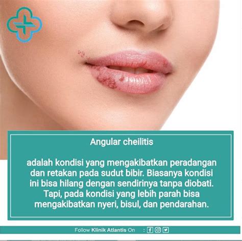 Antibiotics For Angular Cheilitis