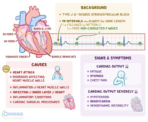 Mobitz Type II What Is It Diagnosis Treatment And More Osmosis