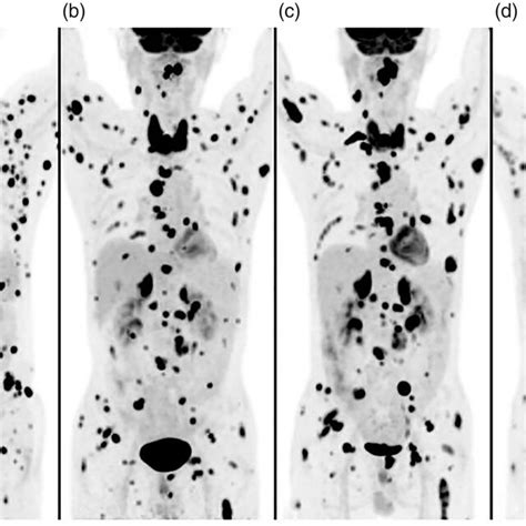 Evaluations Of 18f Fluorodeoxyglucose Fdg Uptake A1 Multiple Download Scientific Diagram