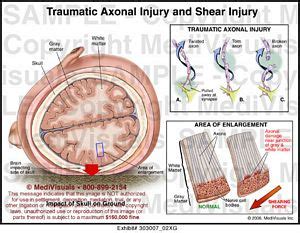 Traumatic Axonal Injury And Shear Injury Medical Exhibit Medivisuals