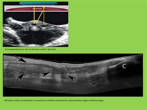 Ultrasound Artifactspptx