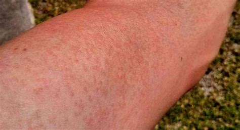 Natural Ways To Prevent Itching After Using A Tanning Bed