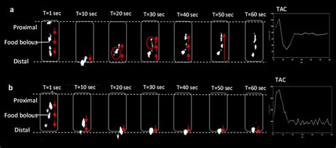 Bolus Reflux On 60 S Nuclear Scintigraphy Esophageal Swallow Study