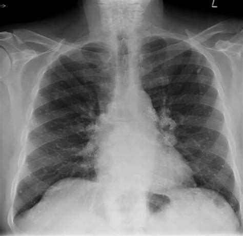 Silicosis Eggshell Calcification