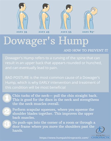Humpal Chiropractic Dowagers Hump What Is It Can I Prevent It