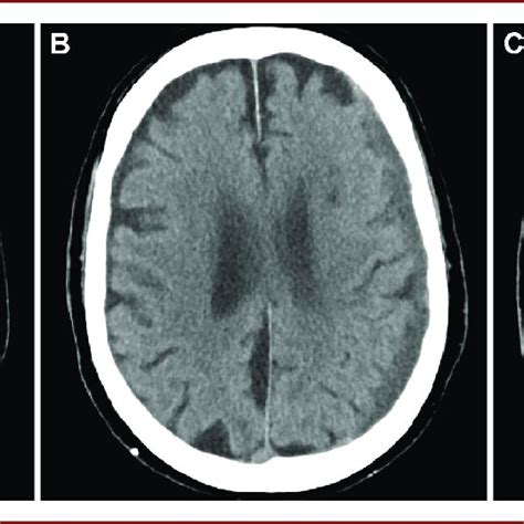 Left Convexity Csdh In A 96 Yr Old Male Treated With Left Mma Download Scientific Diagram