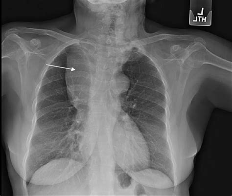 Chest Radiograph Shows A Large Soft Tissue Mass In The Upper Right Download Scientific Diagram