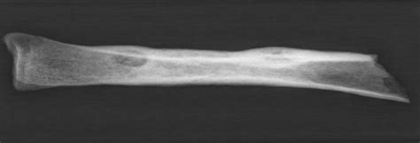 Lesions Caused By Syphilis On The Tibia Download Scientific Diagram