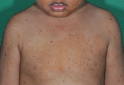 What Is Plane Xanthoma At Cassandra Wild Blog