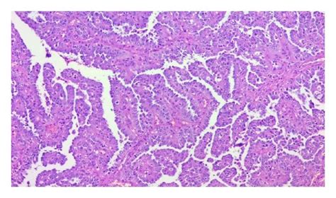 A Tumor Pseudocapsule Composed Of Fibrous Tissue Hande Stain × 50