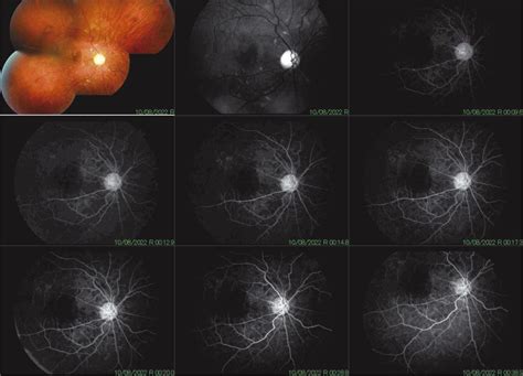 Oclusión Mixta De La Vena Central De La Retina Y De Rama De La Arteria Central De La Retina