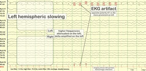 EKG