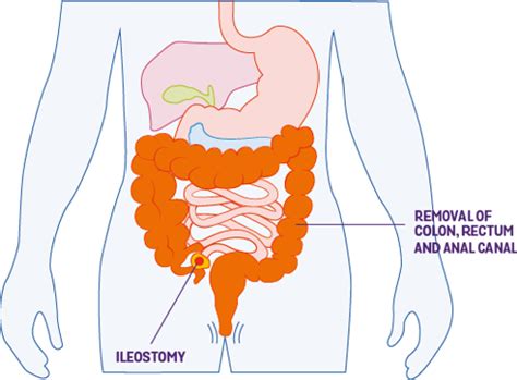 Surgery For Crohns Disease