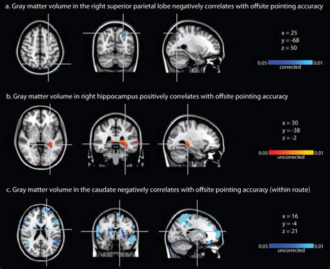 Voxel Based Morphometry Vbm Results A Negative Correlation Between