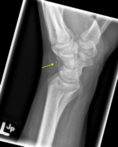 Cervical Burst Fracture Radiology At St Vincent S Uni