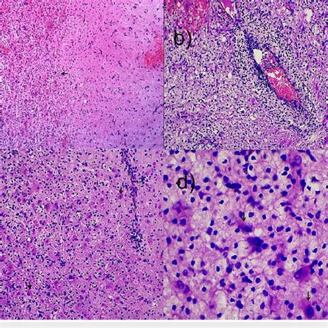 Histomorphological Features Of Tumefactive Demyelination A Tissue