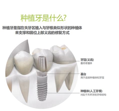 种植牙应该如何选择种植体？