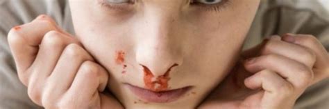 How To Stop A Nose From Bleeding Yoors