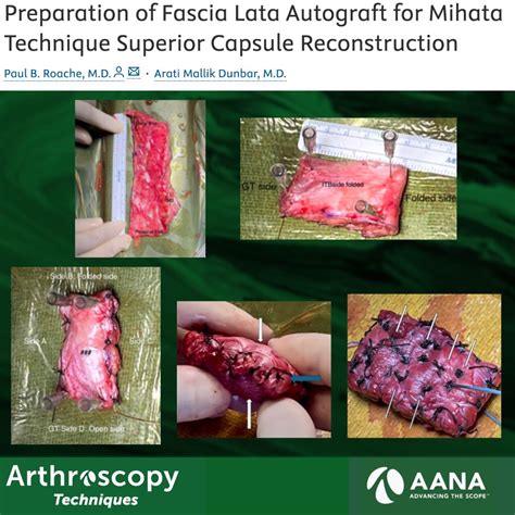 Arthroscopy Journals On Linkedin Ortho Sportsmedicine Arthroscopy
