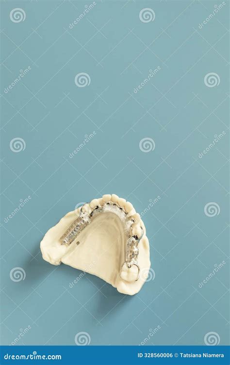 Lower Partial Denture With Attachments Royalty Free Stock Image