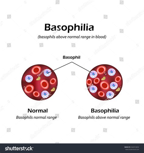 Basophils Above Normal Range Blood Basophilia Stock Illustration