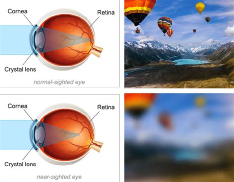 Blog Early Myopia Detection And Management Mainline