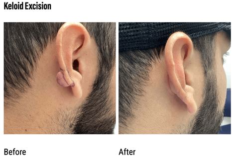How Do I Get Rid Of Keloids A Comprehensive Guide