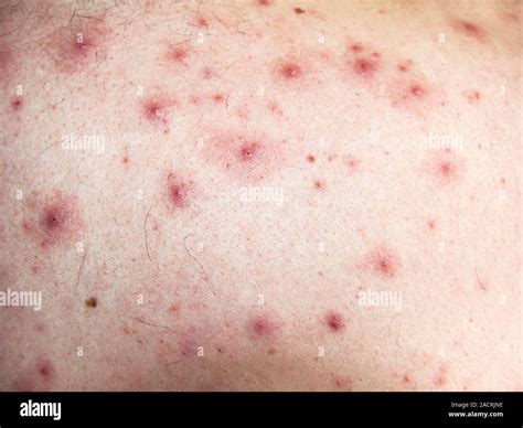 Acne Pustules Close Up Of A Mans Upper Back And Shoulder Area