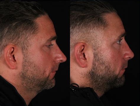 Herstel Van Een Scheve Neus Na Een Ongeval Door Neuscorrectie