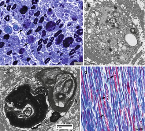 Nerve Biopsy Evaluation Neupsy Key